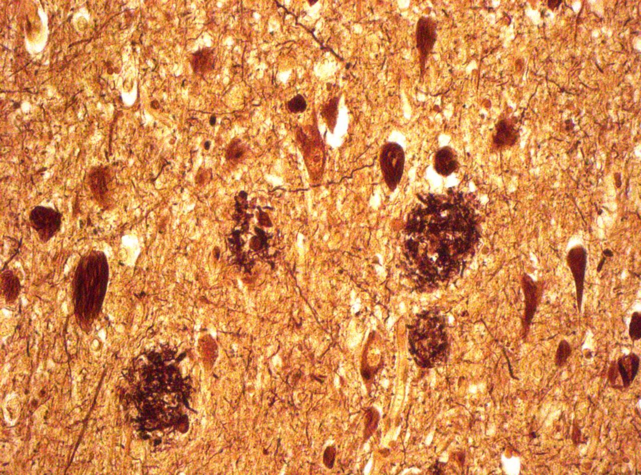 Mediathek - Bild | Senile Plaques bei Alzheimer