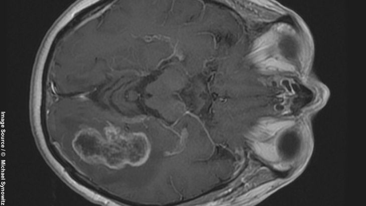 Neurochirurg der Charité im Interview über Hirntumore: „Gliome sind ...