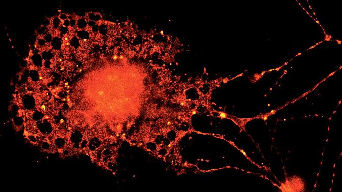Neurochirurg der Charité im Interview über Hirntumore: „Gliome sind ...