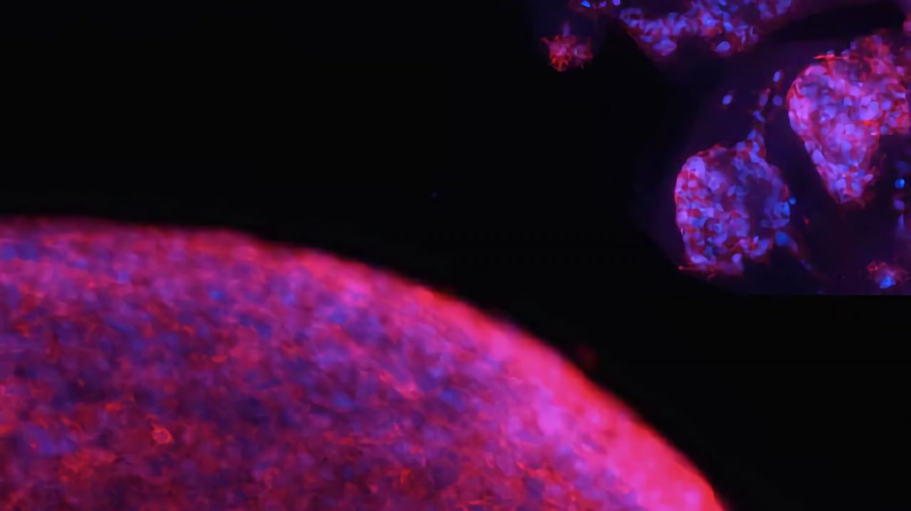 Neurochirurg der Charité im Interview über Hirntumore: „Gliome sind ...